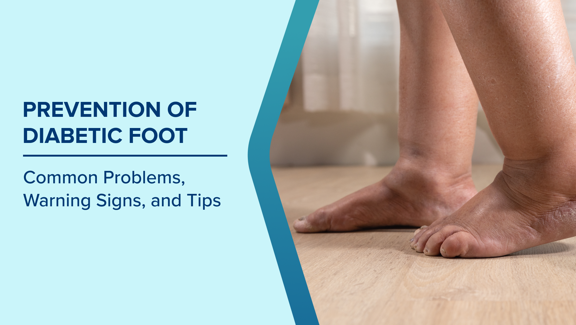 Prevention of Diabetic Foot: Common Problems, Warning Signs, and Tips ...
