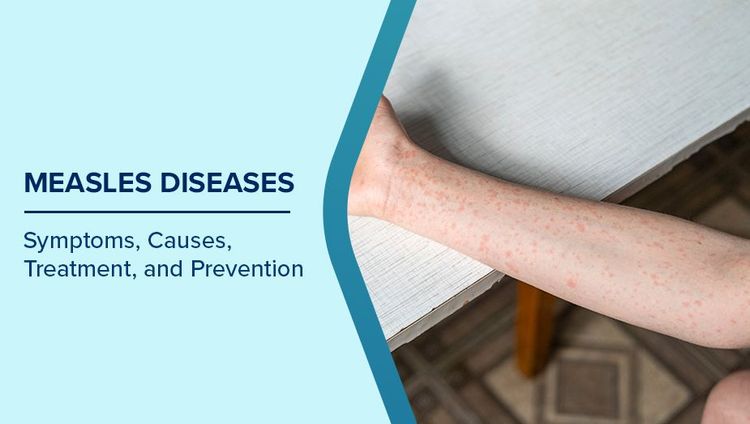 Measles Disease: Symptoms, Causes, & Treatment | Max Hospital